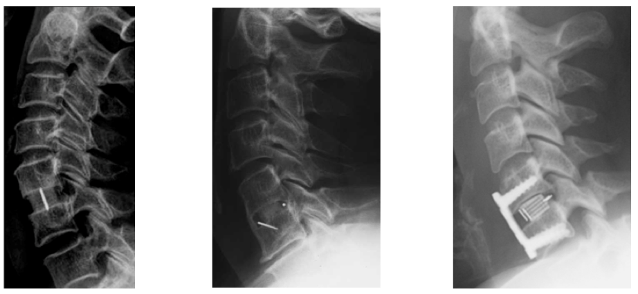 Le traitement chirurgical du canal cervical étroit - Neurochirurgie Nice