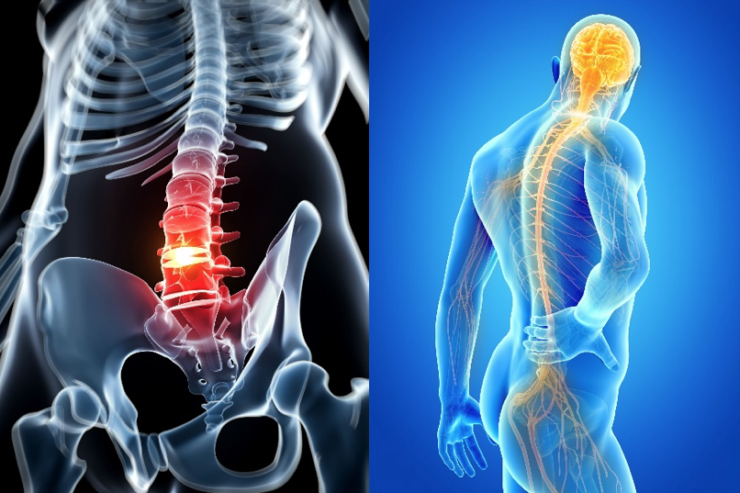 discopathie Les symptômes et l’évolution, le diagnostic - Chirurgie du ...